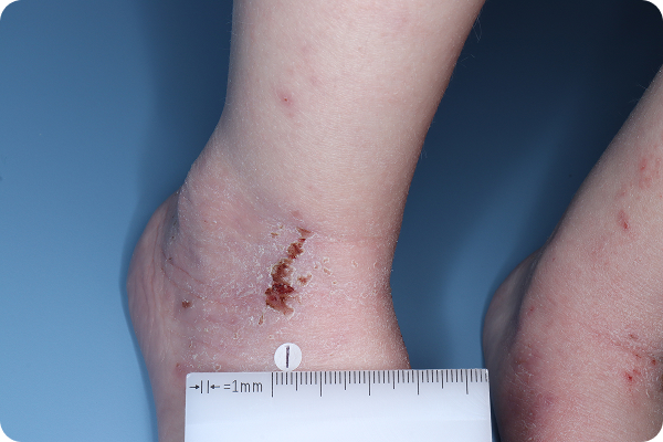 Visible Results - VTAMA® (tapinarof) cream, 1%