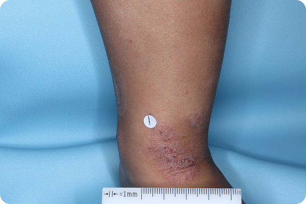 Visible Results - VTAMA® (tapinarof) cream, 1%