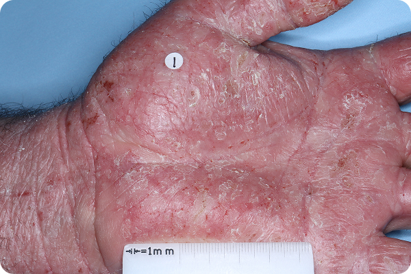 Visible Results - VTAMA® (tapinarof) cream, 1%