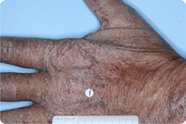 Visible Results - VTAMA® (tapinarof) cream, 1%